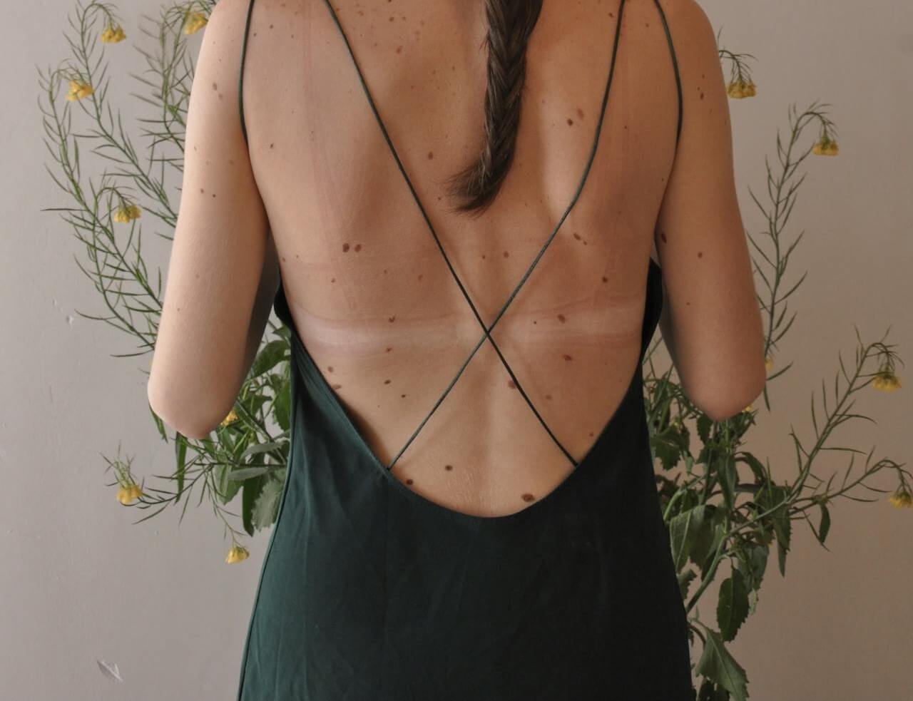 Spiritual Meaning of Birthmarks, Moles & Freckles On Your Body